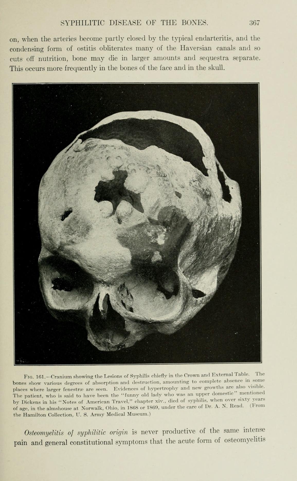 How Syphilis in the 1800s Drove People to Madness and Death - History ...